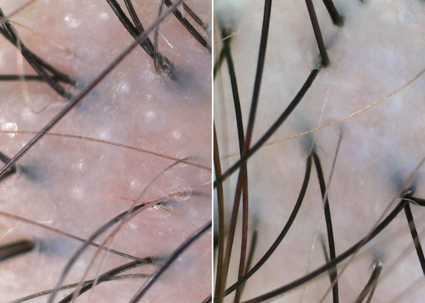 Scalp treatments for hair loss: How to start your hair rescue ...